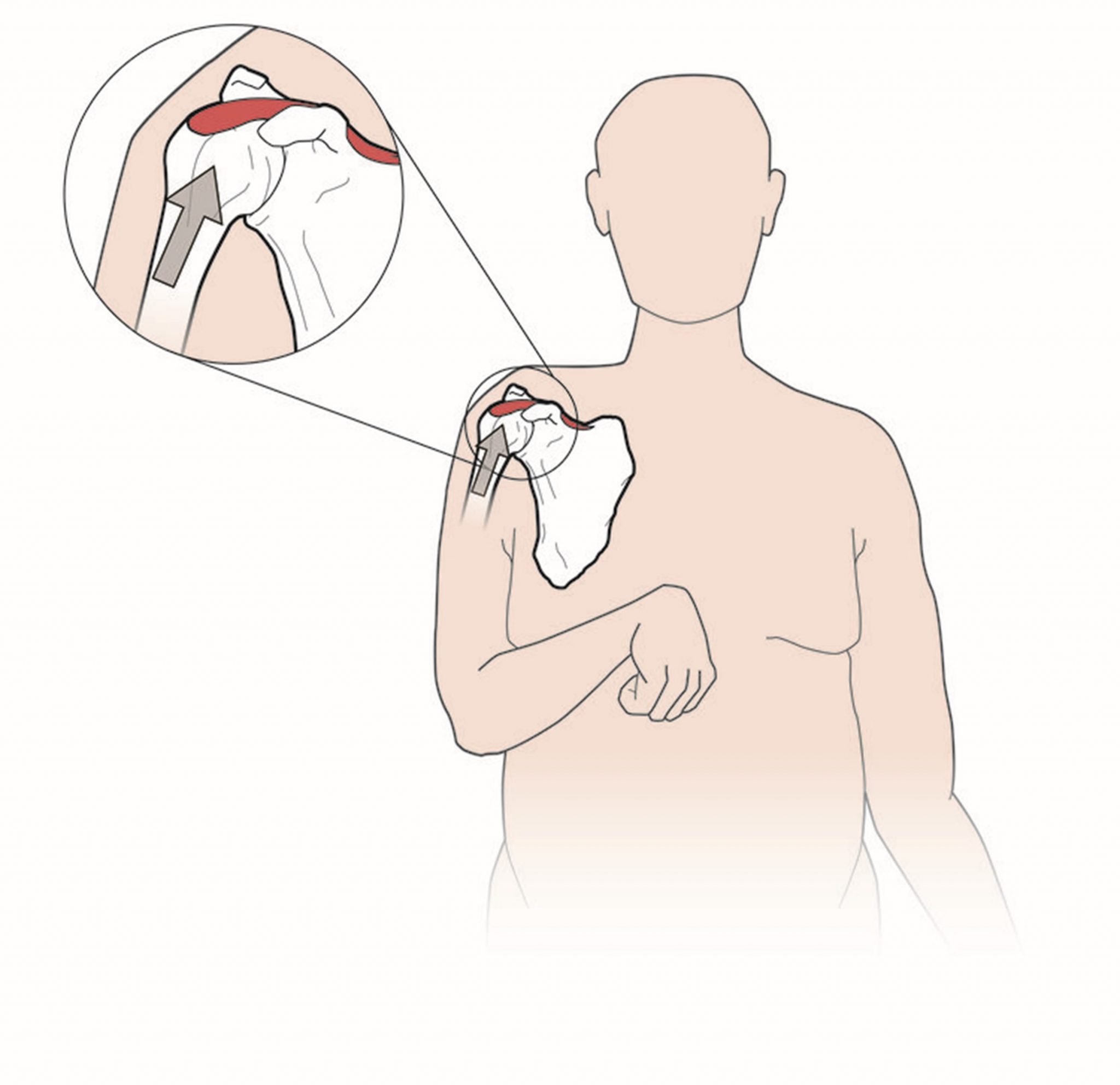 Shoulder Pain - Guide for Stroke Recovery